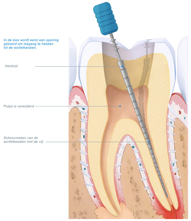 Kliniek voor Tandheelkunde Utrecht - Endodontologie